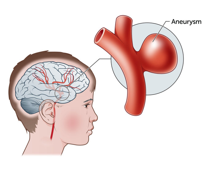 Clipping / Coiling of Brain Aneurysm - Dr. Sandip Mavani